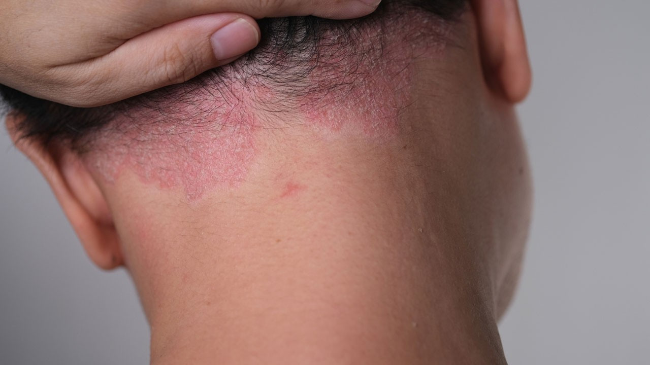 Seboreik Dermatit Hastalığı Nedir? Tedavisi Nasıl Yapılır? - Sağlık ...